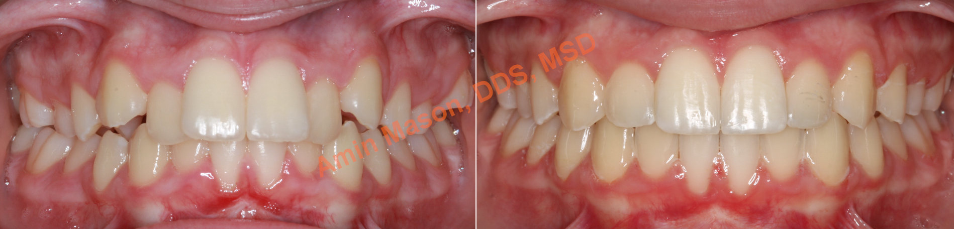 Case of the Month! - Columbus Orthodontic Center Blog